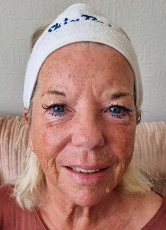 Hydro Before & Afters - skinbasepro.com