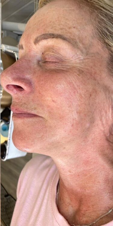 Hydro Before & Afters - skinbasepro.com