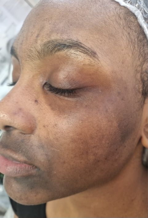 Hydro Before & Afters - skinbasepro.com