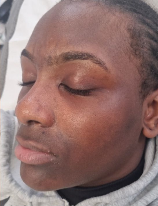 Hydro Before & Afters - skinbasepro.com