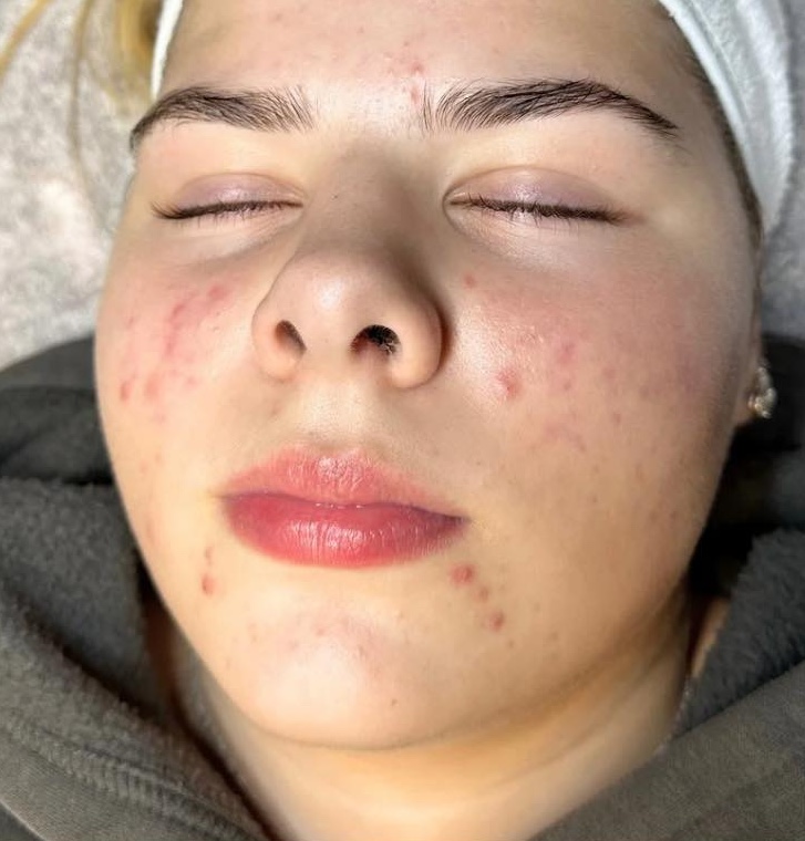 Microdermabrasion Before & Afters - skinbasepro.com